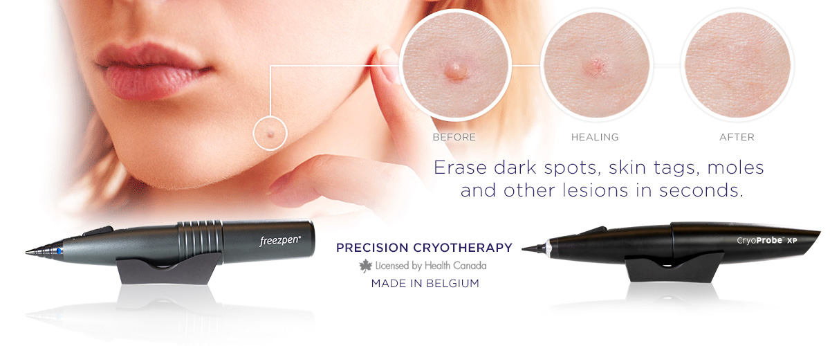 Freezepen - Inspire Skin and Laser